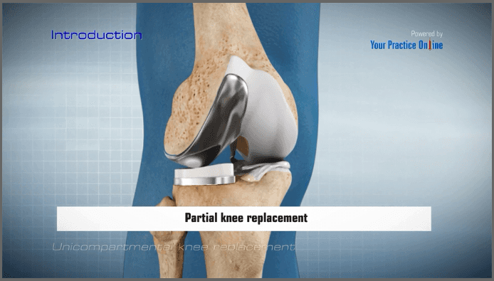 Breakthrough Knee Cartilage Replacement: A New Era for Joint Health ...